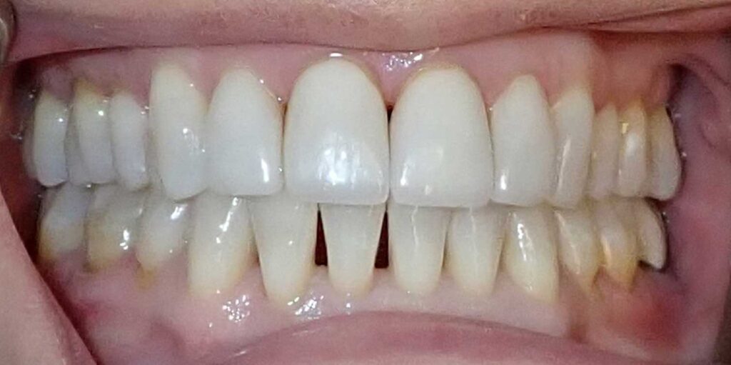 Best Bioclear® in Los Angeles, CA | Beach Cities Dentistry