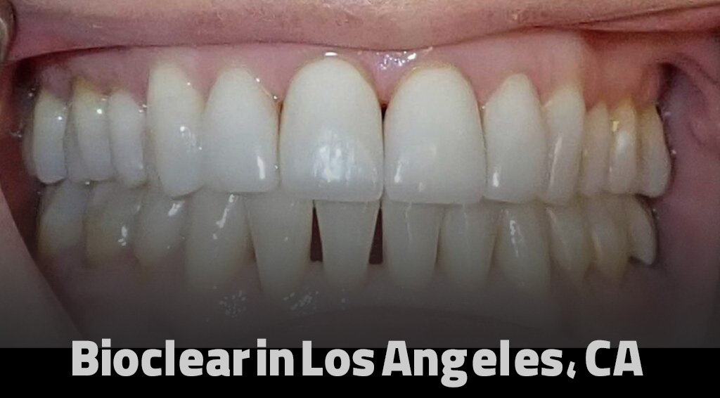 Best Bioclear® in Los Angeles, CA | Beach Cities Dentistry
