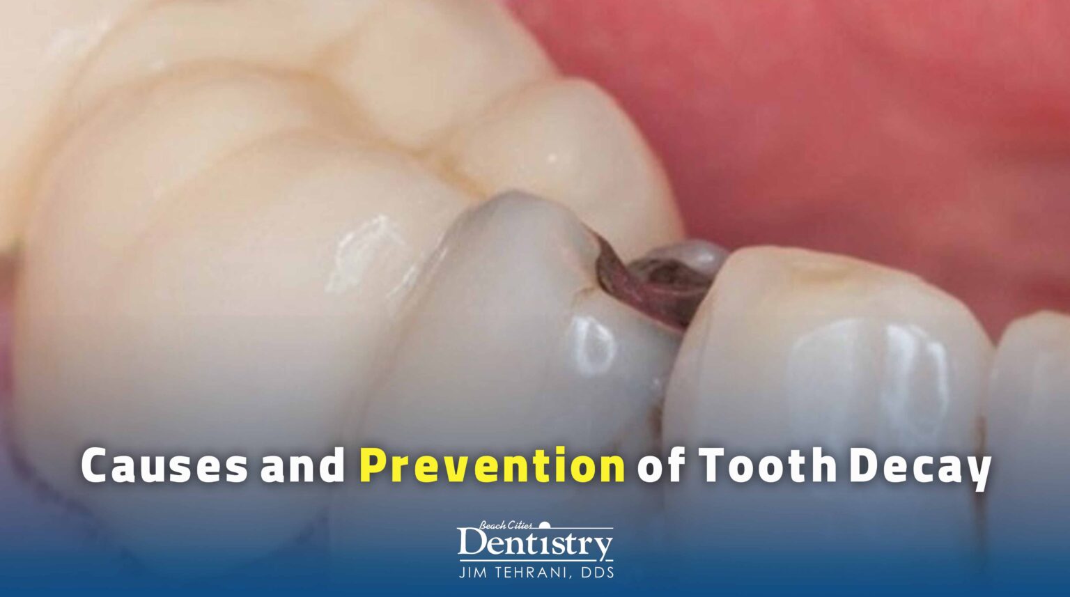 Causes and Prevention of Tooth Decay