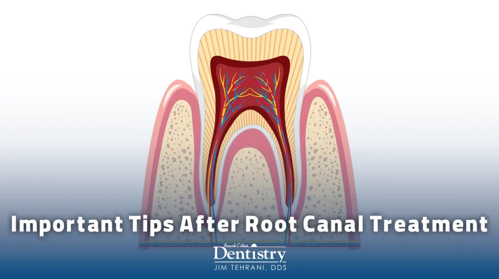 Important Tips After Root Canal Treatment