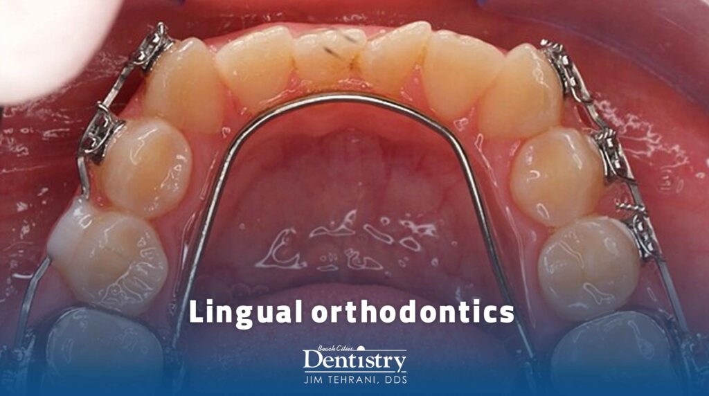 Lingual orthodontics - Beach Cities Dentistry