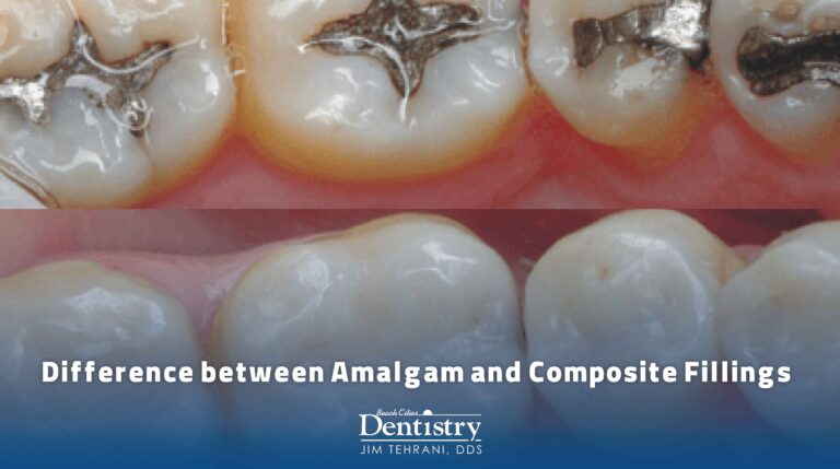 Difference between Amalgam and Composite Fillings
