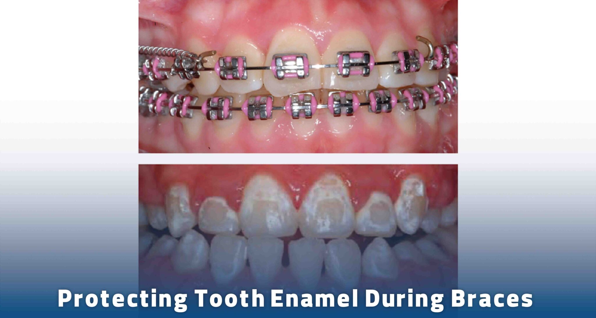 Protecting Tooth Enamel: Tips for Orthodontic Patients