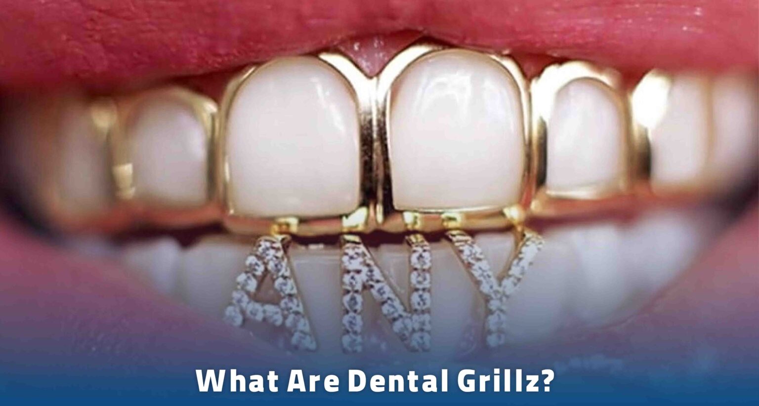 What Are Dental Grillz?